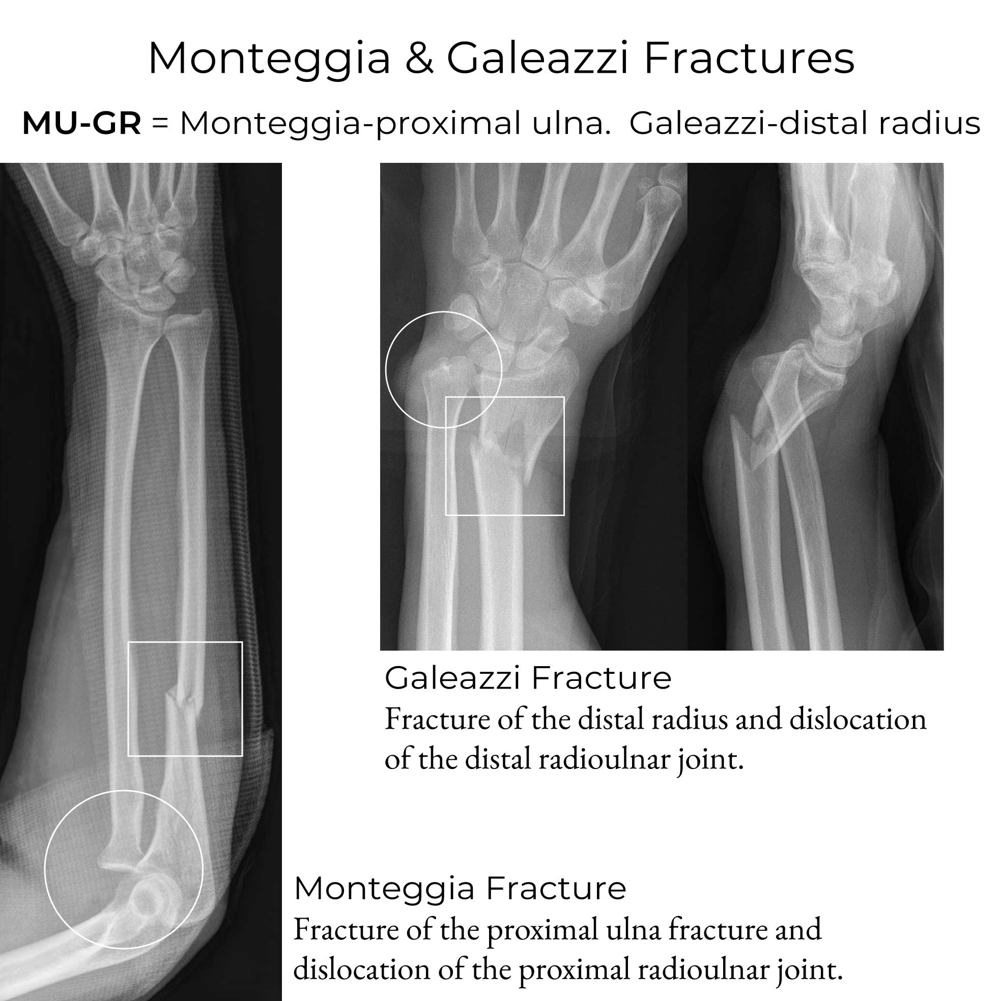 Combined Monteggia And Galeazzi Fractures Image Dr Matthew Wilkinson Combined Monteggia And Galeazzi Fractures Image Dr Matthew Wilkinson
