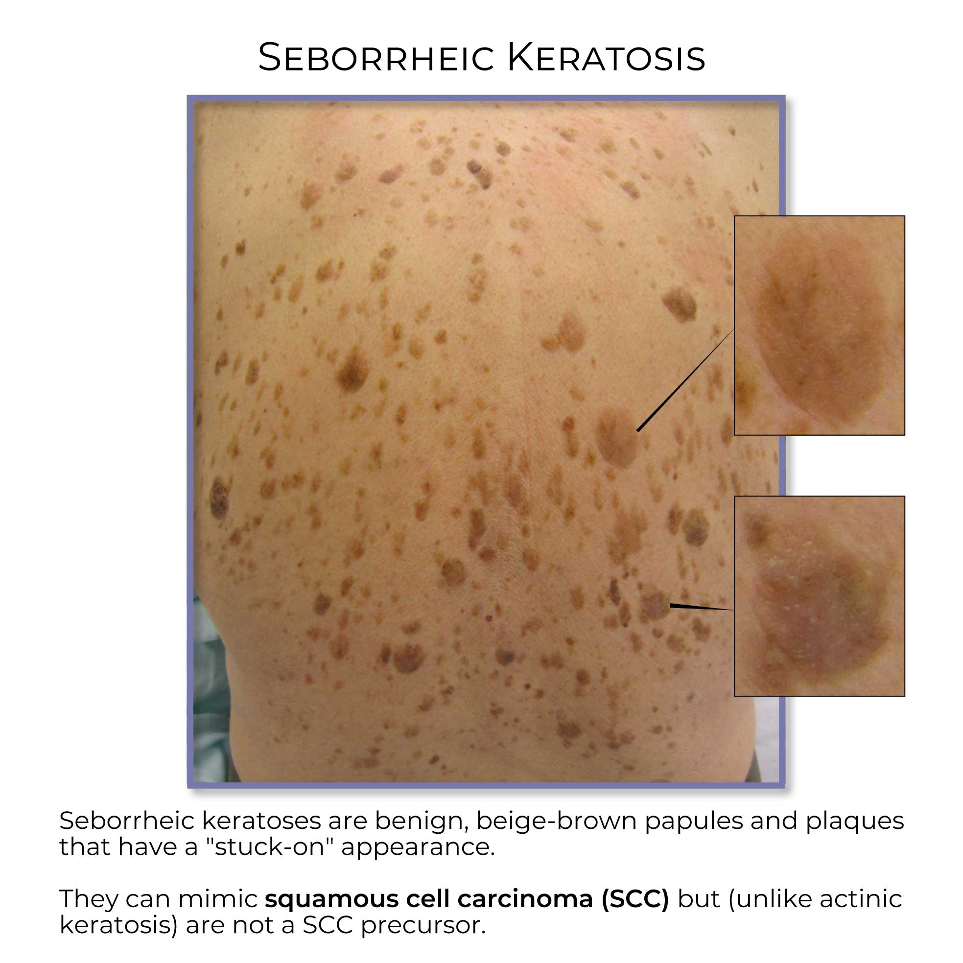Christmas Tree Pattern Seborrheic Keratosis