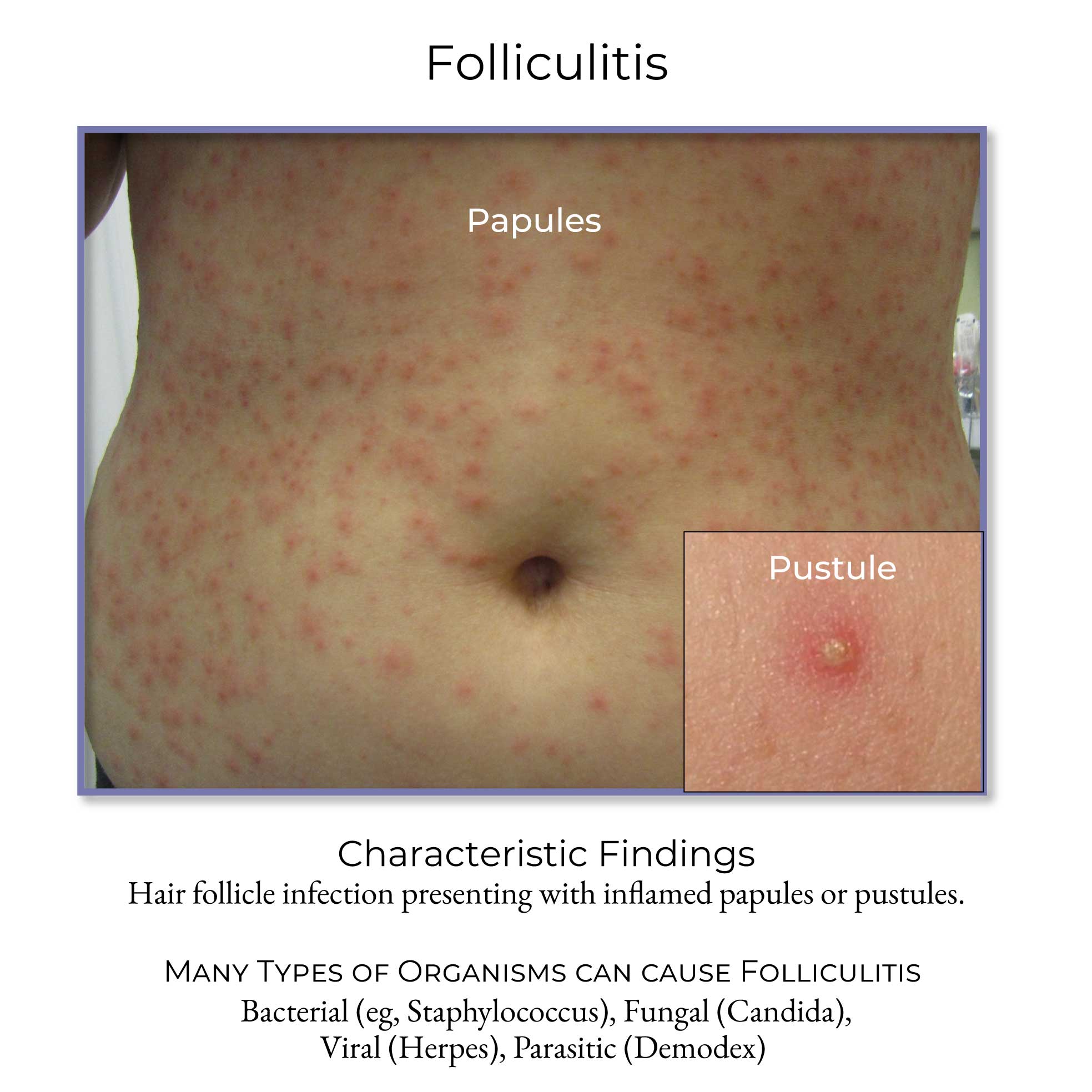 Clinical Medicine: Common Skin Lesions | ditki medical & biological ...