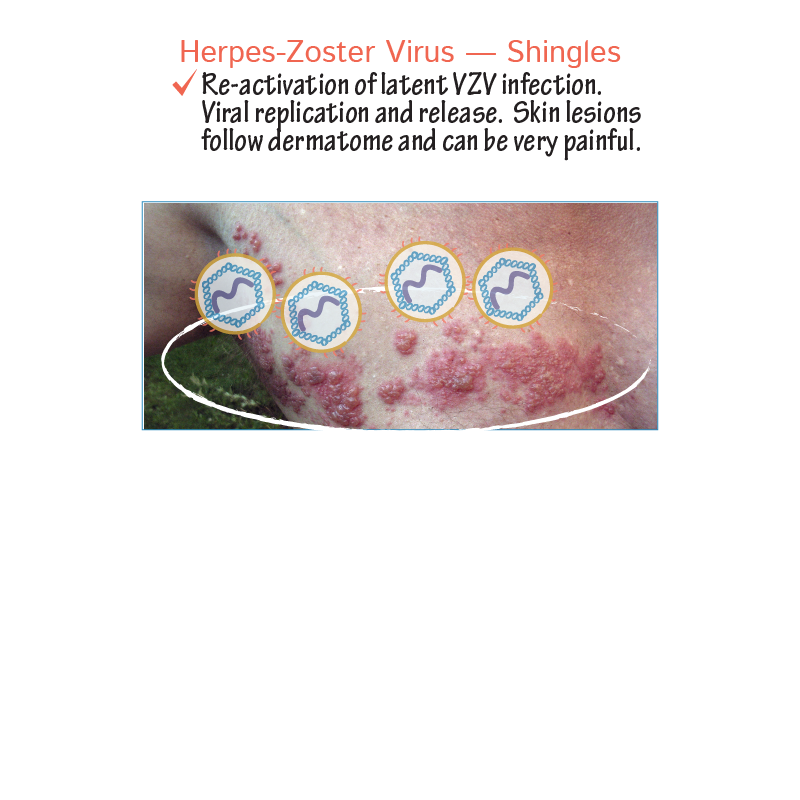 Immunology / Microbiology Glossary: Varicella-Zoster Virus (aka, HHV-3 ...
