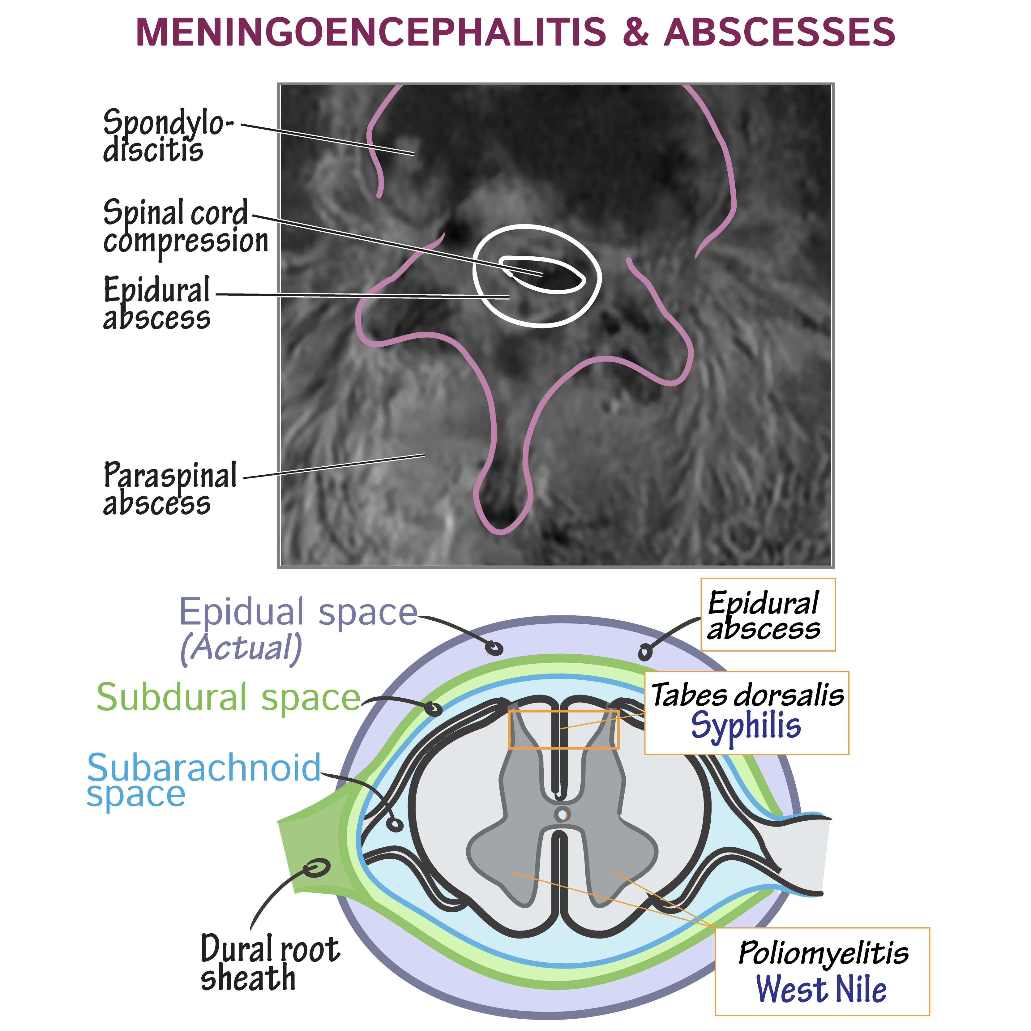 Clinical Pathology Glossary: Meningitis Essentials | ditki medical ...