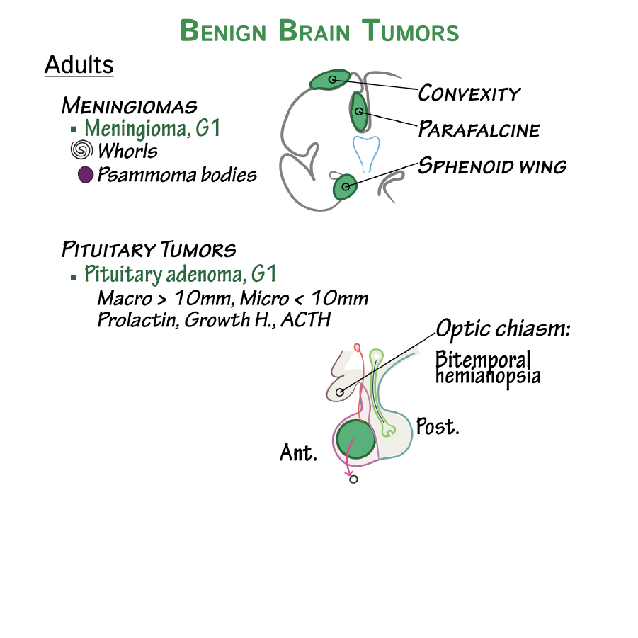 Neuroanatomy Glossary: Common Brain Tumors | ditki medical & biological ...