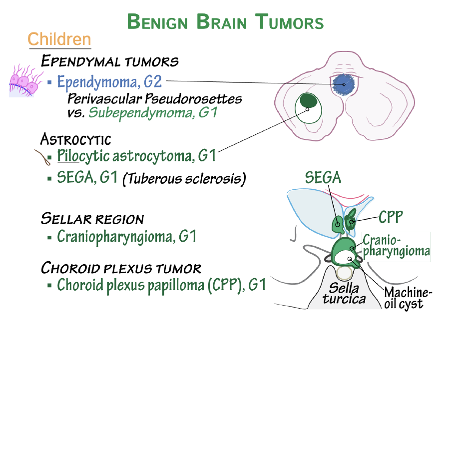 Neuroanatomy Glossary: Common Brain Tumors | ditki medical & biological ...