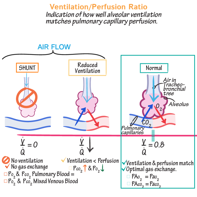 Ventilation Perfusion Ratios V Q Defects Physiology Flashcards