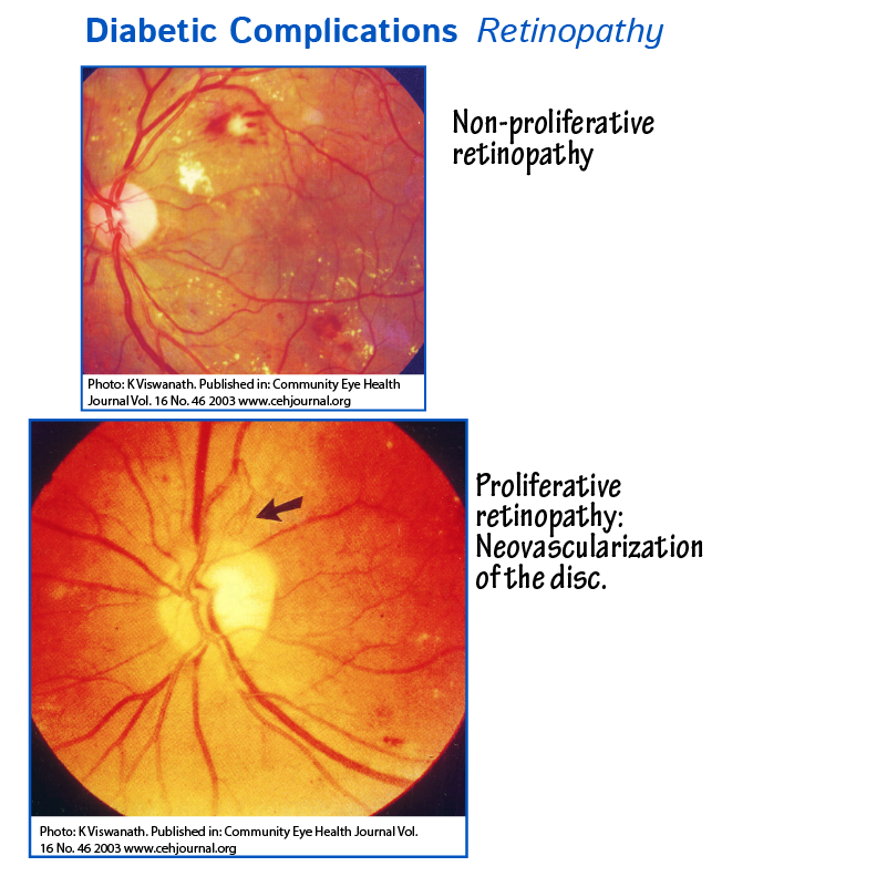 Clinical Pathology Glossary Diabetic Retinopathy Ditki Medical