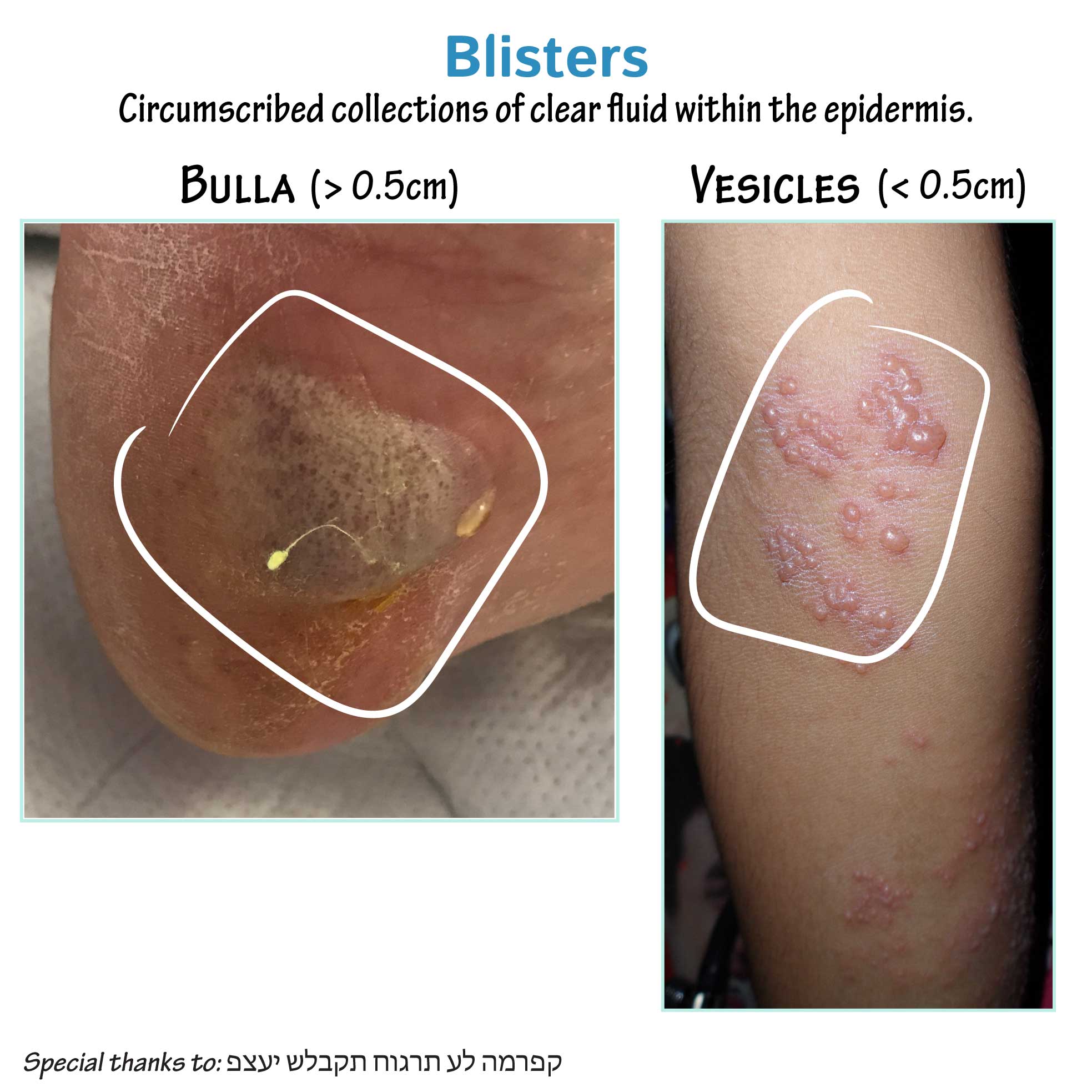 Clinical Pathology Glossary: Bulla (aka Blister) | ditki medical ...