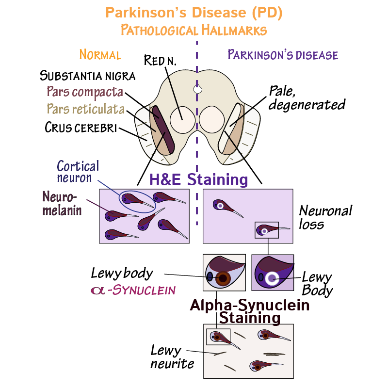 Neuroanatomy Glossary: Parkinson's Disease | ditki medical & biological ...