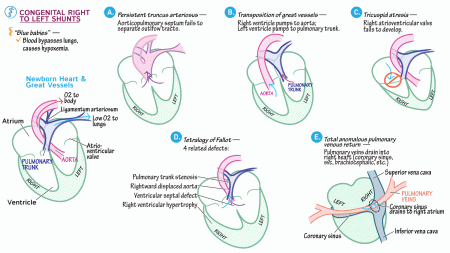 Embryology: Congenital Right to Left Shunts | ditki medical ...