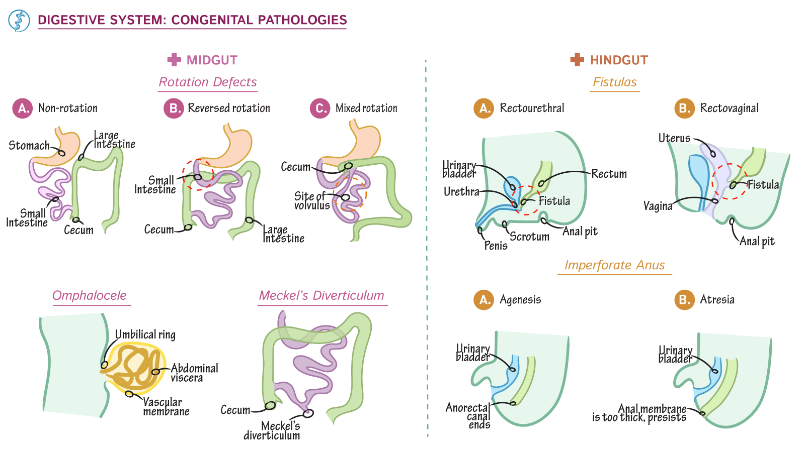 Clinical Pathology: Congenital Intestinal Defects | ditki medical ...