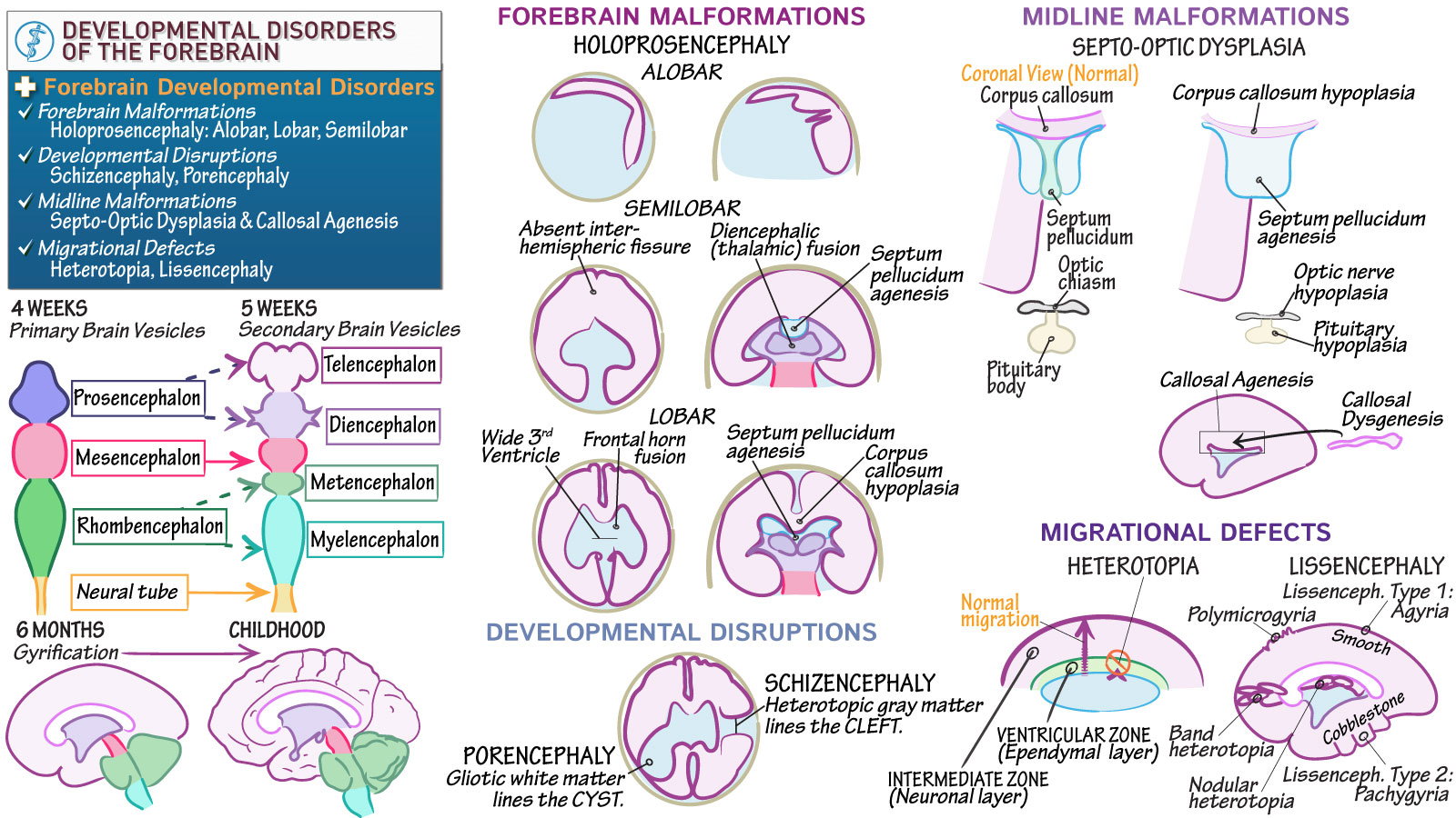 Embryology: Forebrain Developmental Disorders (eg, Holoprosencephaly ...