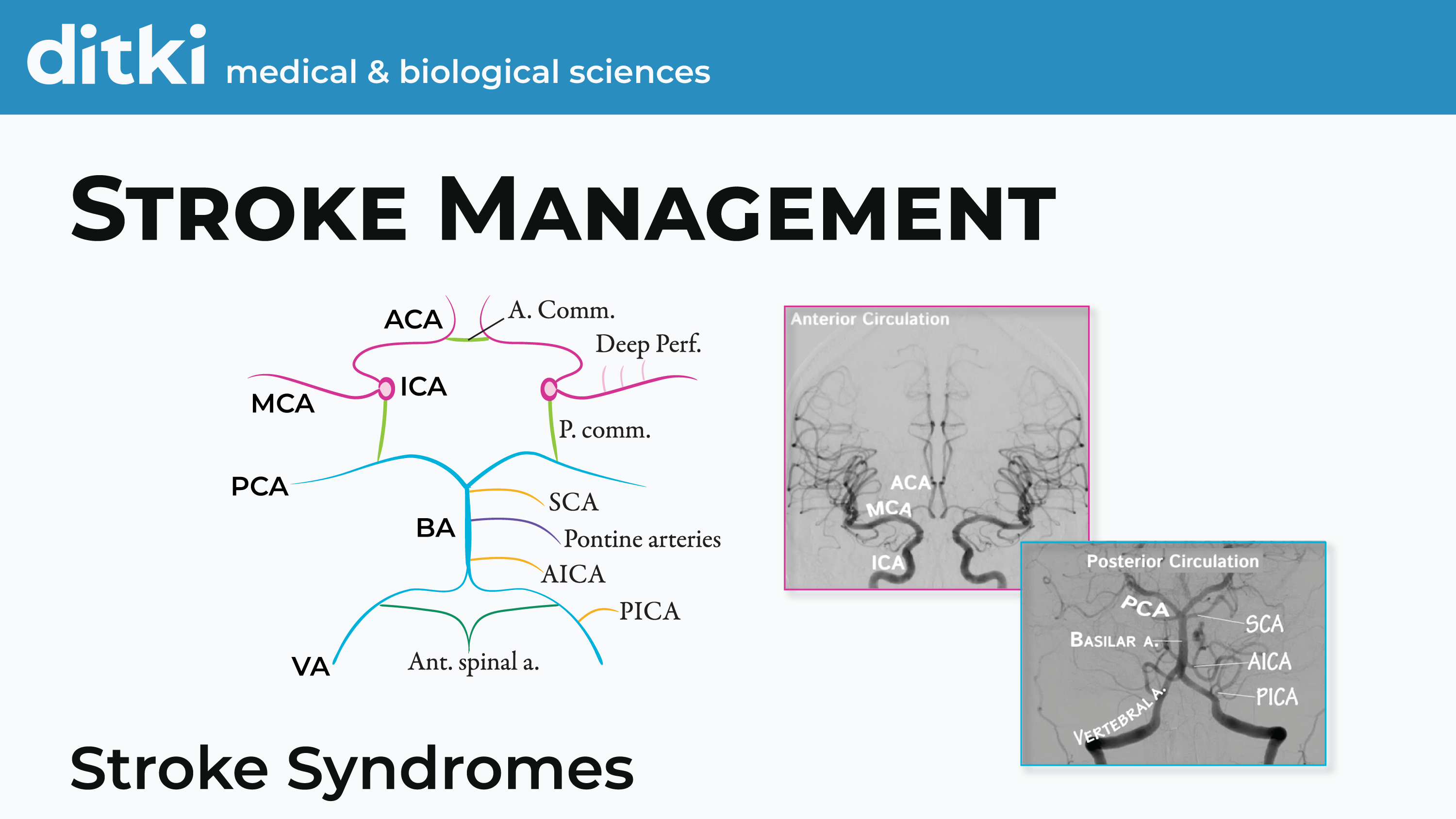 A&P for Nurses: Stroke Syndromes | ditki medical & biological sciences