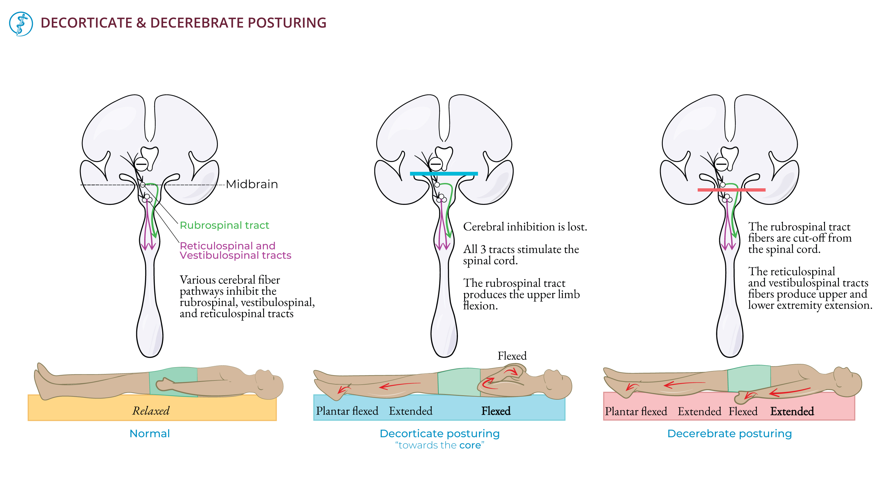 Neuroanatomy: Decorticate & Decerebrate Posturing | ditki medical ...
