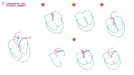 Gross Anatomy: Congenital Left to Right Shunts | ditki medical ...