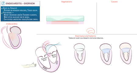 Clinical Medicine: Endocarditis Overview | ditki medical & biological ...