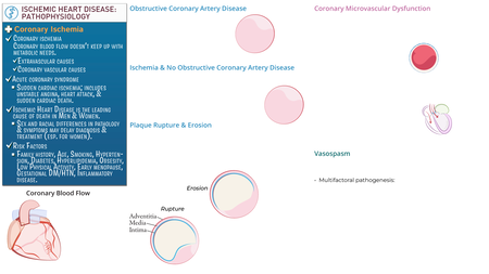 USMLE / COMLEX - Step 1: Ischemic Heart Disease: Pathophysiology ...