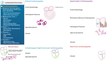 A&P for Nurses: Cardiomyopathies | ditki medical & biological sciences