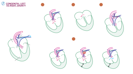 Gross Anatomy: Congenital Left to Right Shunts | ditki medical ...