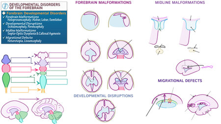 Clinical Pathology: Forebrain Developmental Disorders (eg ...
