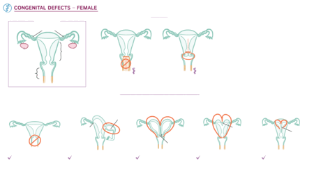 Gross Anatomy: Congenital Anomalies of the Uterus and Vagina | ditki ...
