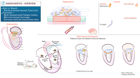 Clinical Medicine: Endocarditis Overview | ditki medical & biological ...