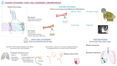 Clinical Pathology: Pleural Effusions & Chest Wall Disorders | ditki ...