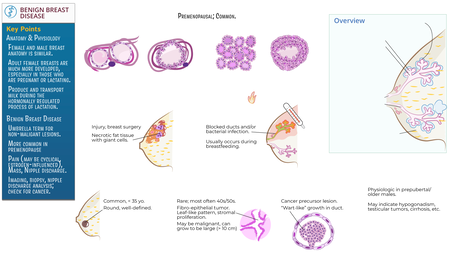 Clinical Pathology: Benign Breast Diseases (Mastitis, Fibrocystic ...